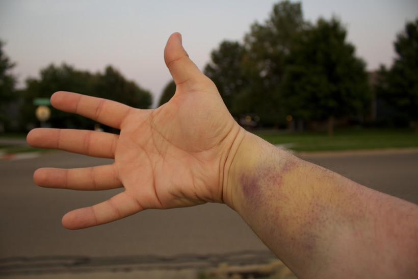 Physical Therapy Advice: Bruising | Wisconsin Public Radio